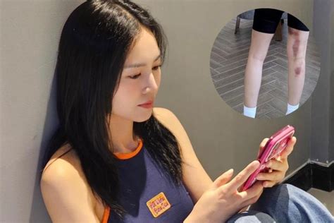 Ninh Dương Lan Ngọc để lộ vết bầm lớn trên cơ thể khiến fan lo lắng Tạp chí SaoStar