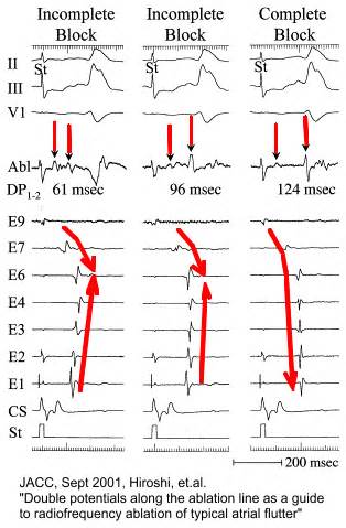 Ablation Of Atrial Flutter Icd 10 Pcs Holdenaccounting