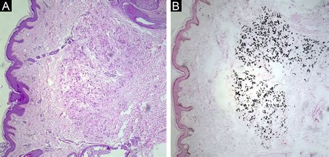 Diagnosis Of Pseudoxanthoma Elasticum In A Patient With Discrete Skin Lesions Anais