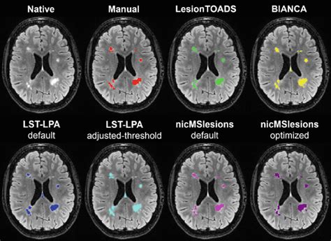 output examples of four lesion segmentation algorithms and manual