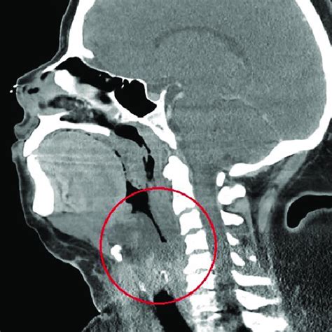 Neck Computed Tomography Scan At The Time Of Admission For
