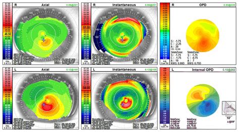 Corneal Topography In The Left Eye At Presentation 3 Years After Download Scientific Diagram