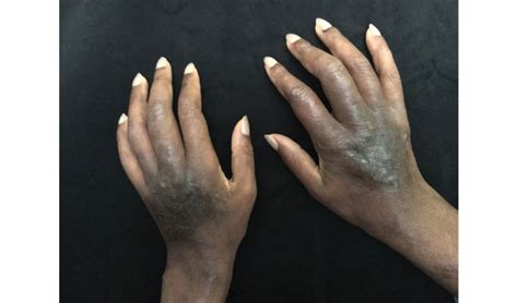 leprosy slideshow