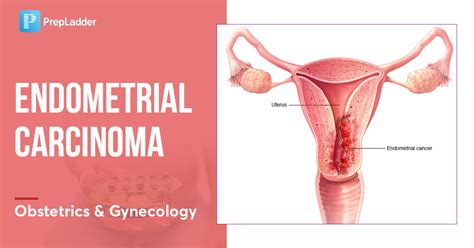 Endometrial Carcinoma Causes Staging And Hyperplasia