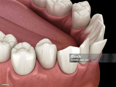 혼잡 한 치아 비정상적인 치과 폐색 의학적으로 정확한 치아 3d 일러스트레이션 붐비는에 대한 스톡 사진 및 기타 이미지 붐비는 부정교합 치아 건강 Istock