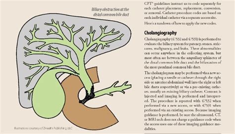 Cpt® 2016 Percutaneous Biliary Interventional Coding