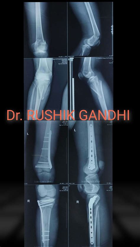 Dr Rushik Gandhi On Linkedin Closed Distal Femur And Upper Tibia Dr Rushik Gandhi On Linkedin Closed Distal Femur And Upper Tibia