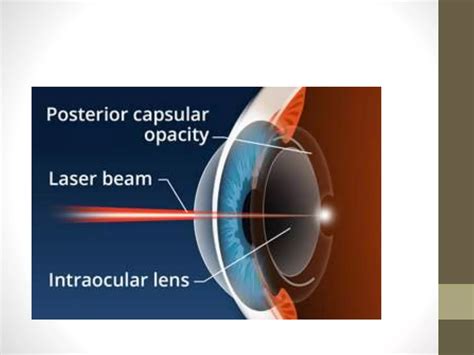 Secondary Cataract Ppt