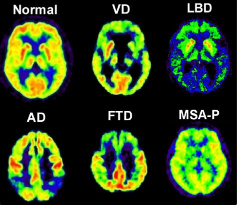 Can Mri Pick Up Dementia at Willis Beane blog