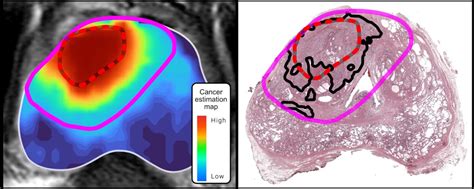 Using Artificial Intelligence To Map Prostate Tumors Cbiit