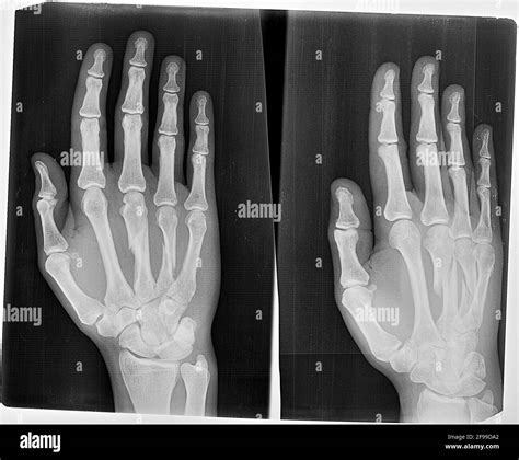 An X Ray Showing A Fracture Of The 3rd And 4th Metacarpal Bones In The