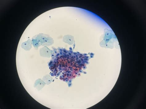 Pap From A 31 Y O Hpv Negative Previous Ascus What Do You Think Jessica Coyne Ct Ascp
