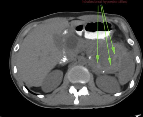 An Axial View Of The Abdomen Showing Intralesional Hyperdensities