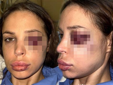 Odmah Zakazana Šavija Mora Na Operaciju Poruka Nasilniku