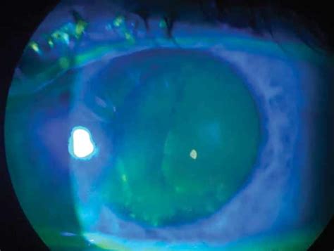Corneal Epithelial Erosion