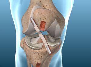 Patient Videos The Centers For Advanced Orthopaedics