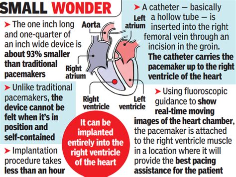 Pacemaker Smallest Pacemaker Implanted At Aiims Bhopal Bhopal News