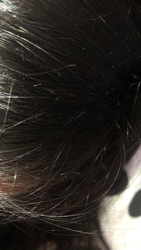 Scabies In Hair Help Im On Day Two Since I Put Permethrin 5 All Over My Face Down To My Toes