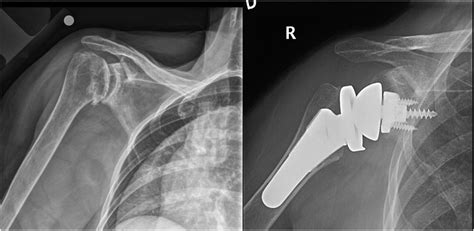 Preoperative And Postoperative Anterior Posterior Radiograph Of An