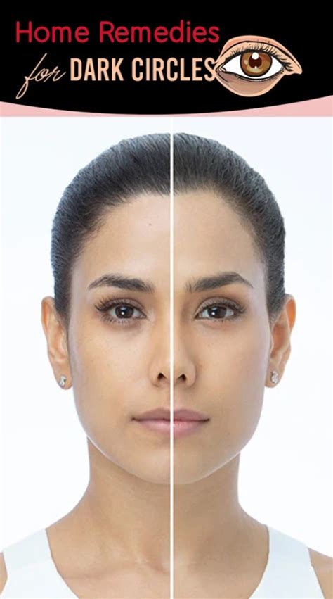 Fastest Way To Remove Dark Circles Naturally At Home In 2 Days