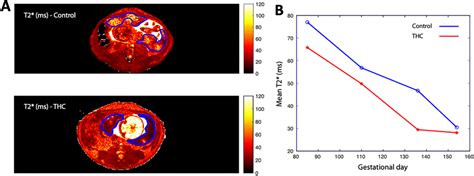 Histogram Plot Of T2 Versus Percent Of Placental Voxels Displayed For