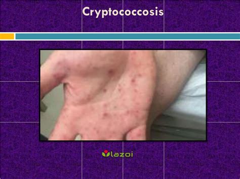 Ppt Cryptococcosis Powerpoint Presentation Free Download Id 7936121