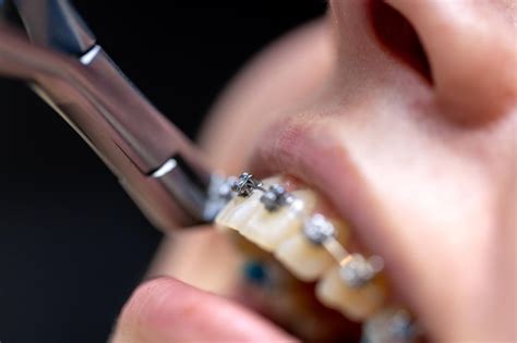 Braces Price In Malaysia Types Costs And Key Considerations