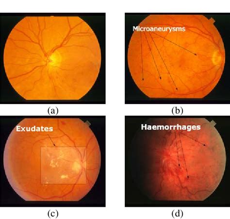 Figure 1 From Microaneurysms Haemorrhages And Exudates Based Diabetic Retinopathy Automatic