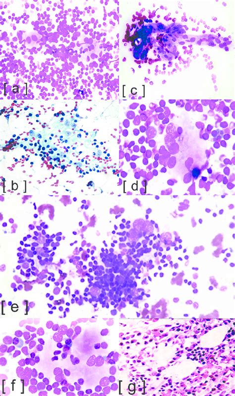 A And B Polymorphous Population Of Lymphoid Cells With A Predominance Download Scientific