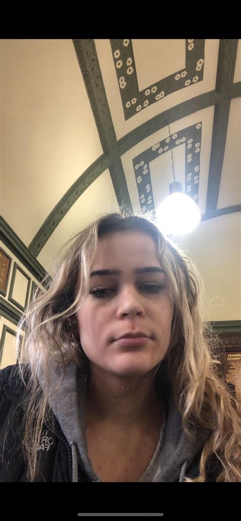 Acromegaly R Acromegaly