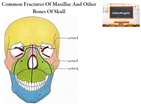 Ethmoid Bone Osteology Notes Class Notes Ethmoid Bone Osteology Notes Class Notes