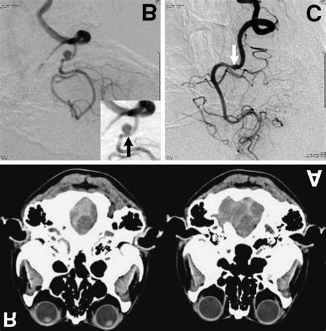 A Initial Computed Tomography Scans Revealing Subarachnoid Clot Mainly