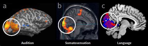Examples Of Cortical Reorganization I E Crossmodal Occipital Download Scientific Diagram