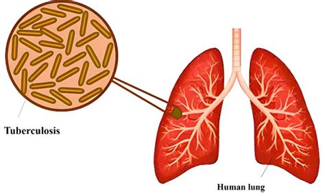 Tuberculosis Cells In Human Lungs Download Scientific Diagram