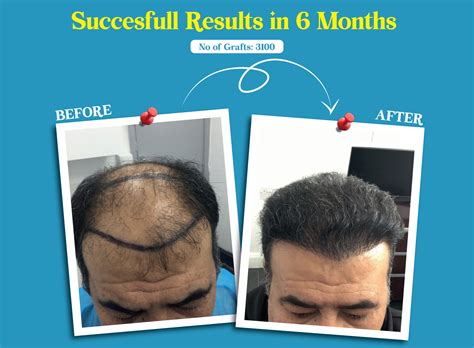 Effective Male Pattern Baldness Treatment Package At My Cosmetic Centre