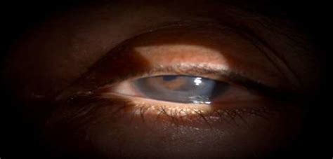 Right Eye With Central Corneal Scar Download Scientific Diagram