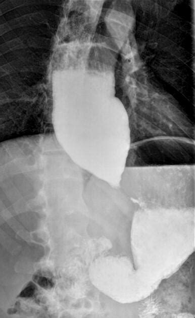 Bird Beak Esophagus