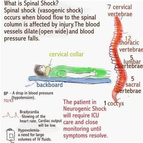 Autonomic Dysreflexia Artofit