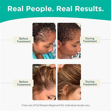 Minoxidil Hair Regrowth Treatment Review At Phyllis Fetter Blog
