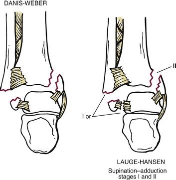 Ankle Fractures Musculoskeletal Key