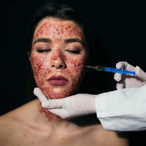 Vampire Facial Dental And Facial Aesthetics