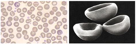 The Hereditary Stomatocytoses Haematologica