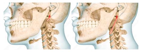 Styloid Process Neck The Sword In The Throat A Rare Case Of A 7 5 Cm