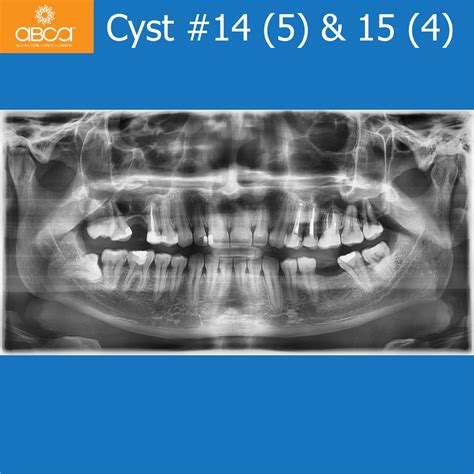 Cyst Enucleation And Apicoectomy 145 And 154 Augma Biomaterials