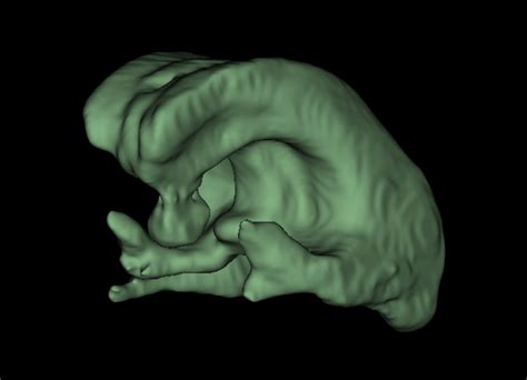 Neonatal Cerebral Lateral Ventricle Segmentation From 3d Ultrasound Images Ai Enabled Medical