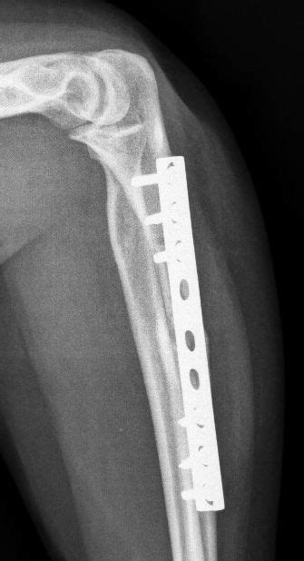 Фрактура луксация на Monteggia