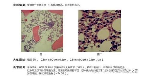 大咖谈病例｜周虎教授点评 原发免疫性血小板减少症（itp）病例解析 知乎