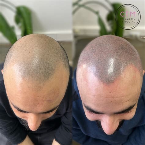 Scalp Micropigmentation Full Head Removable Regrets