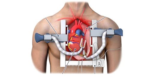 Bypas Nedir Neden Yapılır