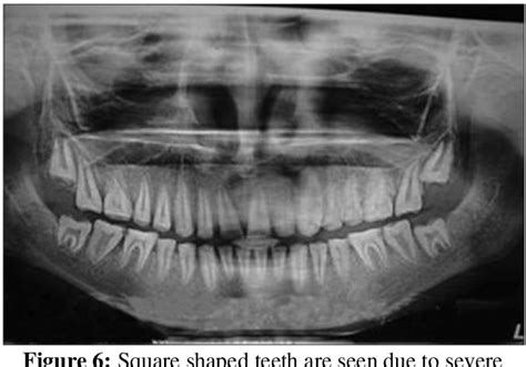 Amelogenesis Imperfecta Radiograph